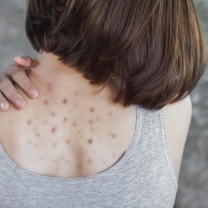 Acantose Nigricans (Mancha Escura na Pele): Entenda o Que É ...