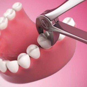 Extração Dentária, Consulta Extração Dentária Belém - Clínica Rede Mais ...